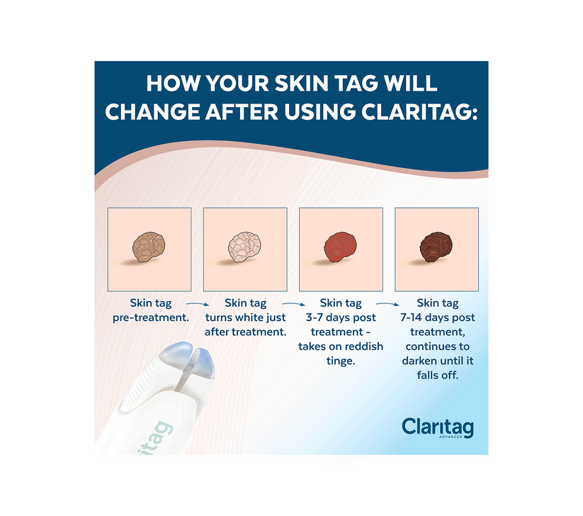 Claritag Advanced® Skin Tag Removal Device