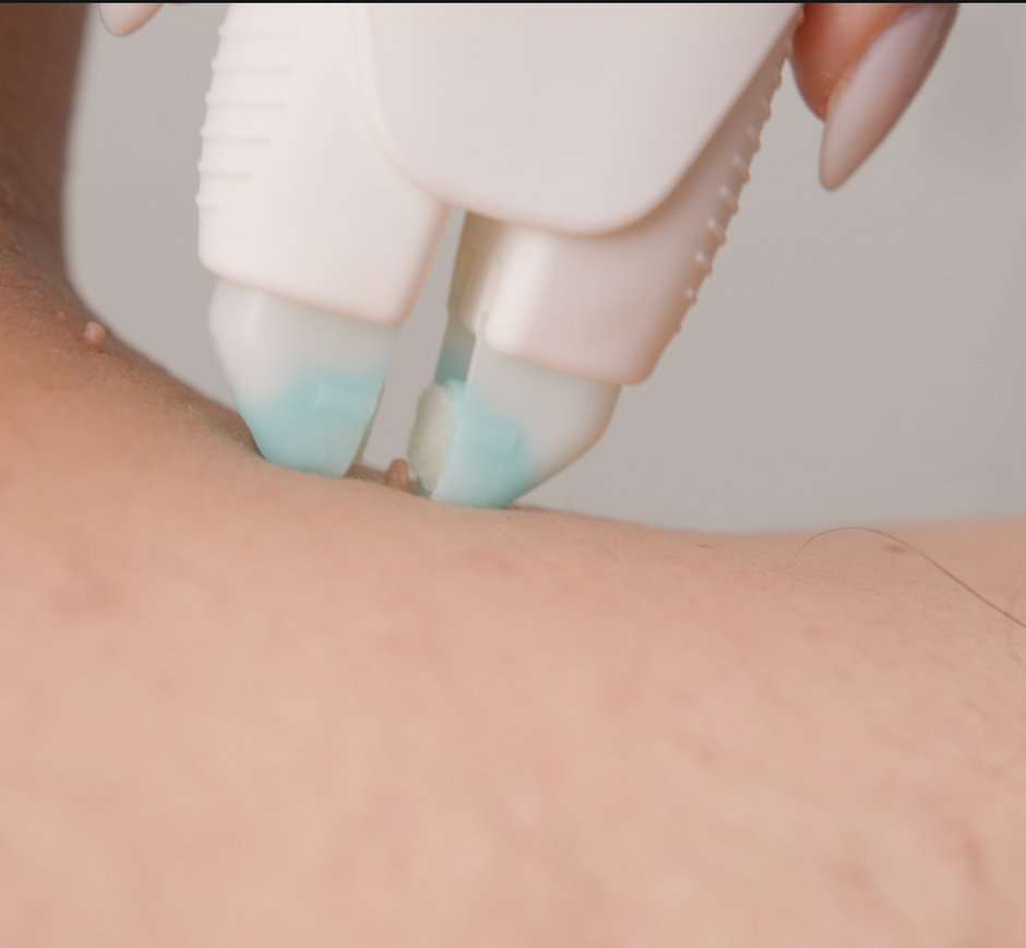 Skin Tag Remover | Claritag Advanced